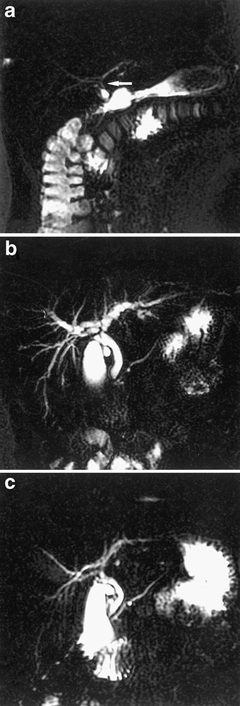 Mr Cholangiogram From Patient B At 7 Years Of Age Before Download