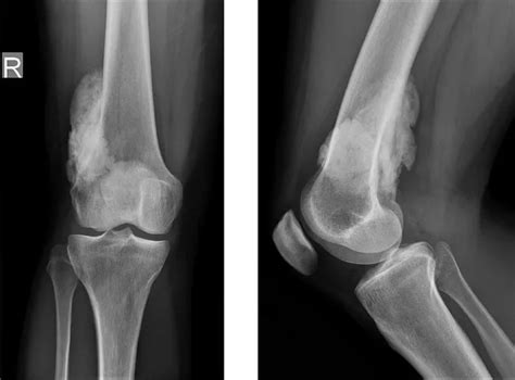 Parosteal Osteosarcoma