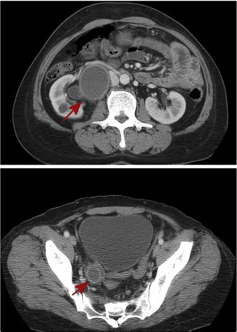 Figure 3 From A Rare Case Of Pyonephrosis Resulting From Tension Free