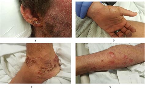 Diffuse Erythematous Rash Showing Involvement In A Earlobe B Hand C Download Scientific