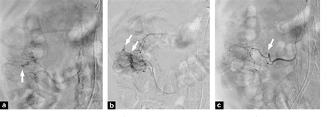 Figure 1 From Efficacy Of Emergency Transarterial Embolization In Acute Lower Gastrointestinal