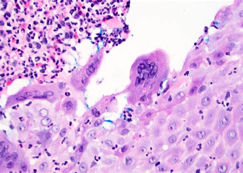 Penile Herpes Pathology Outlines