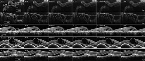 A E Results Of Five Oct Images After Handling With Five Kinds Of