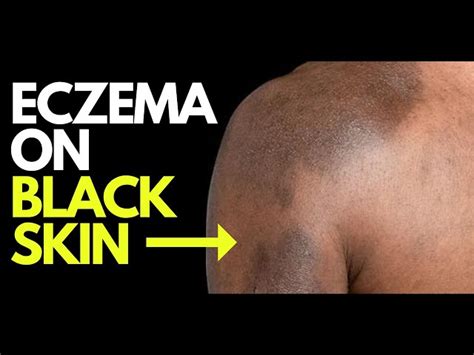 10 Most Common Skin Rashes On Black Skin Hives On Black Skin
