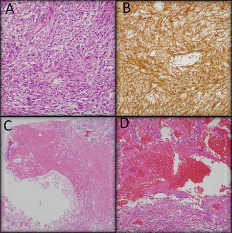 Histopathology Results Of The Resected Lesion The Tumour Is Confirmed Download Scientific