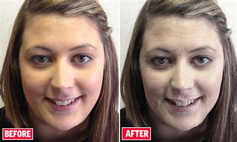 Skin Improvement Before And After Quitting Smoking
