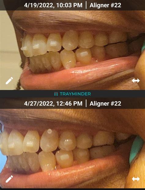 Ipr Rinvisalign