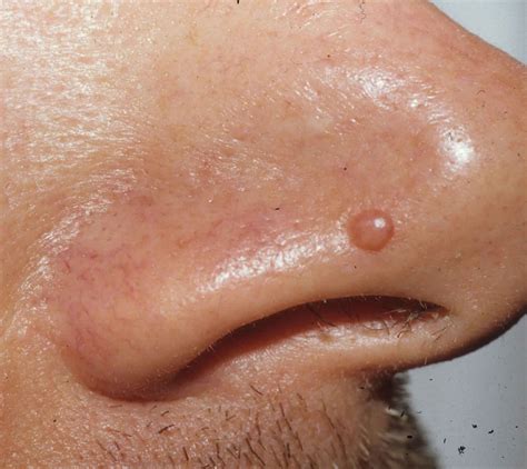 Papule Or Fibrous Papules On Nose Causes Diagnosis And Papule Treatment