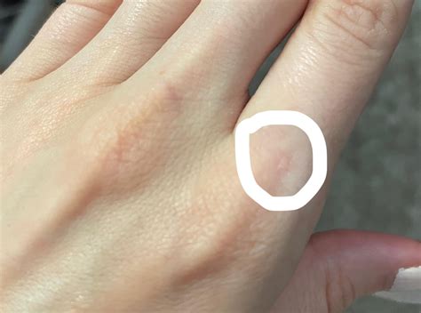 Is This An Early Stage Wart On My Hand Rdermatologyquestions