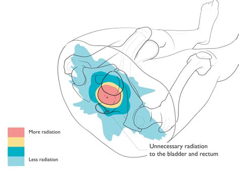 Proton Beam Therapy Prostate Side Effects The Best Picture Of Beam