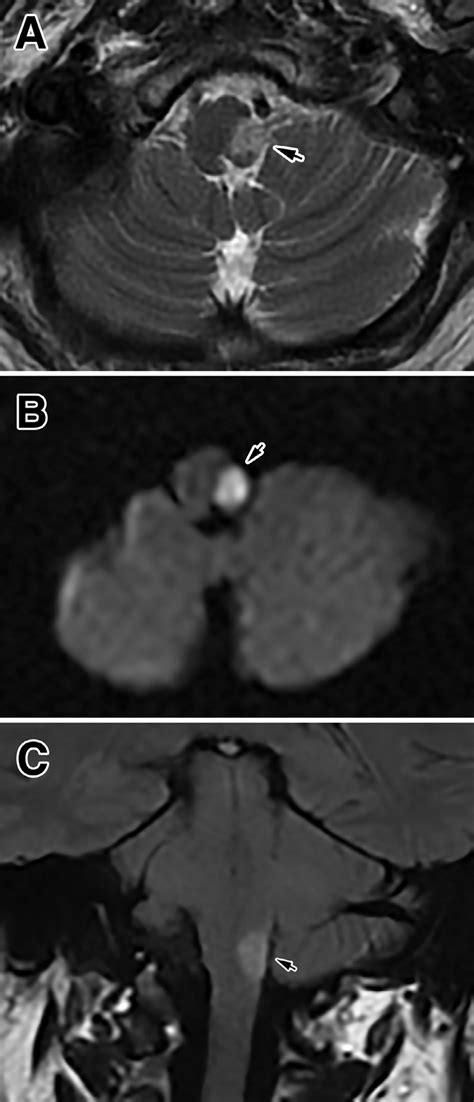 A Left Large Complete Lateral Infarction Arrows Of The Inferior And