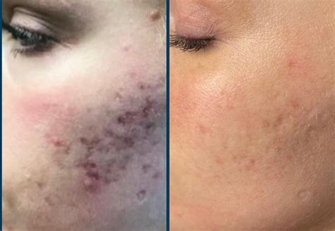 Microneedling For Acne Scars Does It Really Work Collective