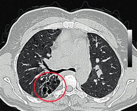 Computed Tomography Image Of The Area Of Bronchiectasis Figure1 Chest