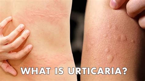 Urticaria Decoding Those Pesky Hives