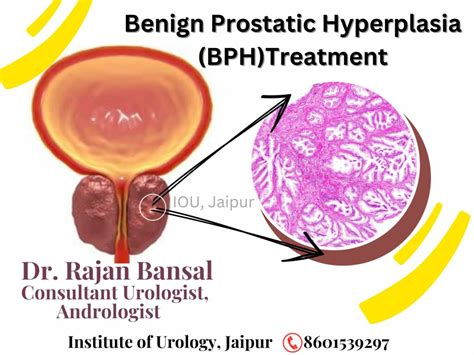 Benign Prostatic Hyperplasia Bph Treatment In Jaipur
