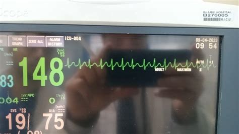 Jamal Mustafa Md On Linkedin Paroxysmal Supraventricular Ventricular