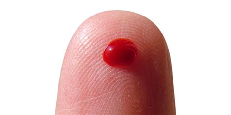 The Dreaded Dexcom Rash Artofit