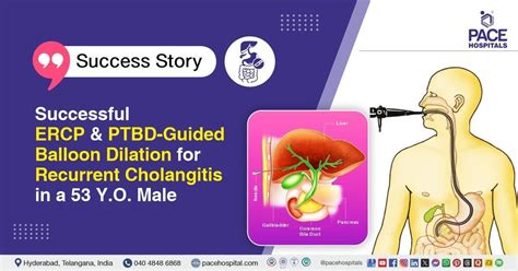 Ercp And Ptbd Guided Balloon Dilation For Recurrent Cholangitis