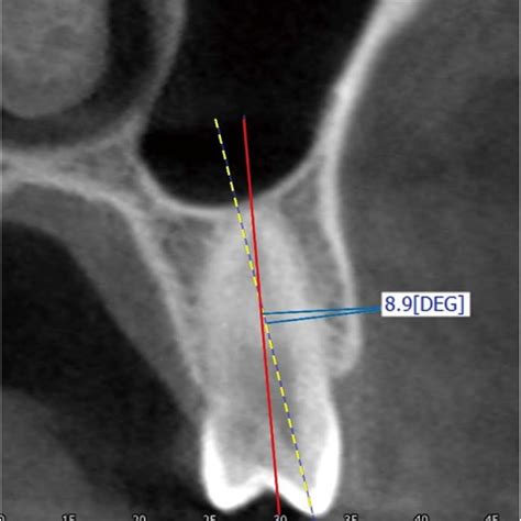 The Long Axis Of The Tooth Is A Line Passing The Midpoint Of The Download Scientific Diagram