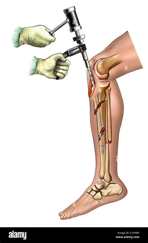 Intramedullary Rod Tibia