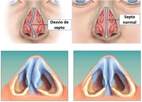Cirurgia De Carne Esponjosa No Nariz Entenda Os Procedimentos