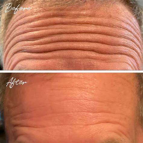 Botox Daxxify Dysport Jeuveau Before And After Ann Arbor Wyandotte MI Med 1 Aesthetics