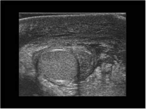 Scrotal Edema Ultrasound