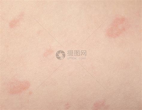 皮肤病荨麻疹皮肤红斑和瘙痒高清图片下载 正版图片504203291 摄图网
