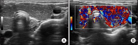 Thyroid Ultrasound Images A Ultrasonographic Findings Revealed A Download Scientific Diagram