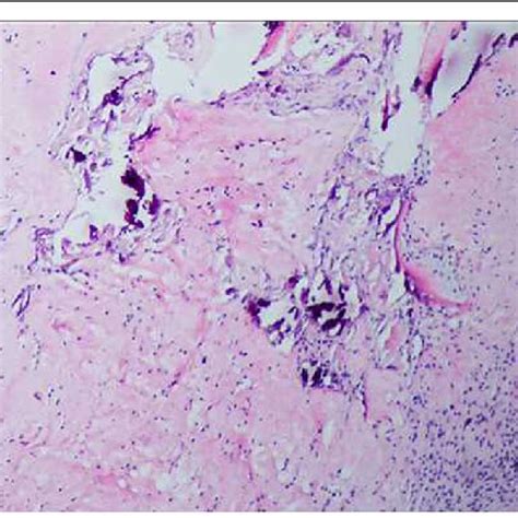 Walch Classification Of Glenoid Morphology In Primary Glenohumeral