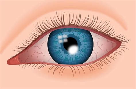 Corneal Ulcer Symptoms Causes Treatment