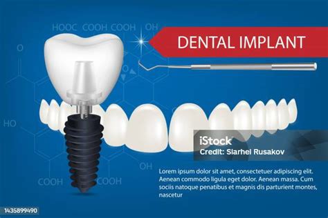 아름다운 치아 모형이있는 파란색 배경에 사실적인 흰색 치과 임플란트 실과 비문이있는 임플란트의 벡터 3d 모델 건강관리와 의술에 대한 스톡 벡터 아트 및 기타 이미지