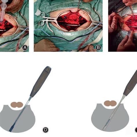 The Detailed Procedure Of The Modified Tes Surgery A Disc Position Download Scientific
