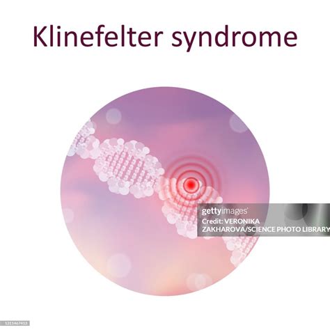 Klinefelter Syndrome Illustration High Res Vector Graphic Getty Images