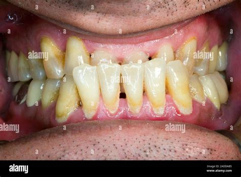 Back Bite Close Up Of The Mouth Of A Patient With A Back Bite Showing
