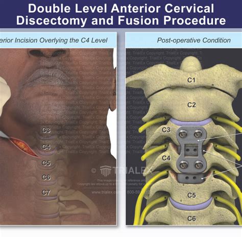 Como Instalar Uma Versao Anterior Cervical Discectomy