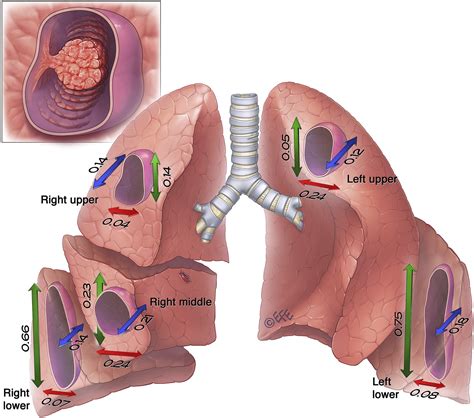 Predictors Of Respiratory Induced Lung Tumour Motion Measured On Four Dimensional Computed
