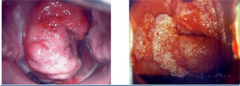 Cervical Screening Refhelp