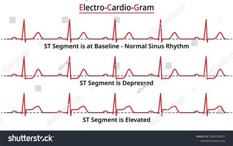Set Of Ecg Common Abnormalities Elevated St Royalty Free Stock