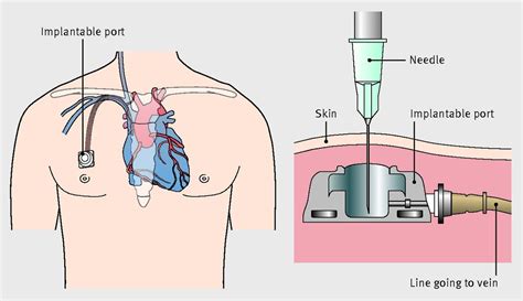 Illustration Of A Totally Implantable Central Venous Catheter Read