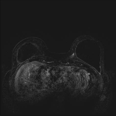 Fifty Six Year Old Woman After Bilateral Mastectomy And Reconstruction