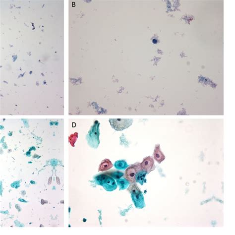 A Thinprep × 10 Before Conversion B Thinprep × 40 Before Download Scientific Diagram A Thinprep × 10 Before Conversion B Thinprep × 40 Before Download Scientific Diagram