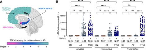 Tdp 43 Pathology Accumulates In Amygdala And Hippocampus Of Ad Tdp A