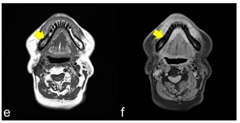Osteomyelitis Jaw Radiographic Appearance