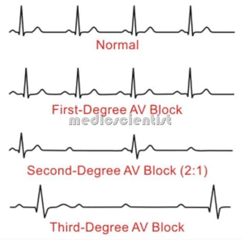 First Degree Av Blocksecond Degree Av Block Mobitz Type Imobitz Type