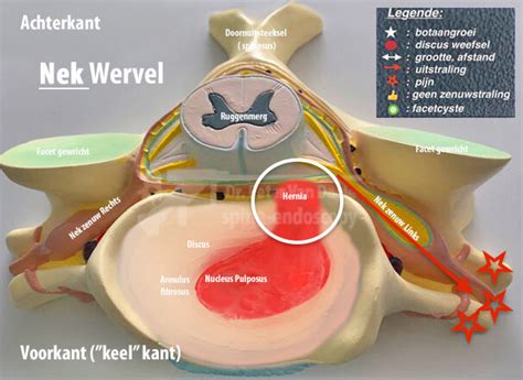 Cervical Disc Herniation Posterior Endoscopic Care — Spine Endoscopy Dr P Van Daele