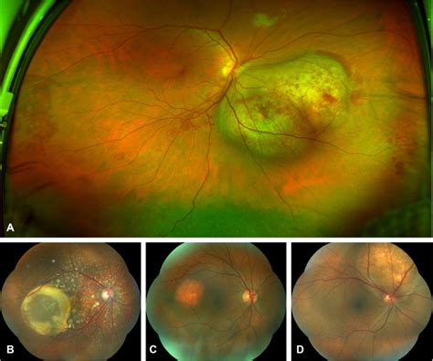 Primary Cancer Sites And Clinical Features Of Choroidal Metastasis In
