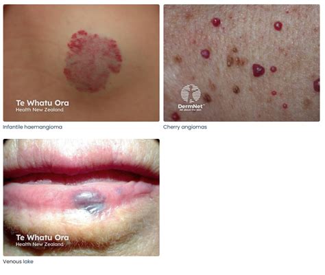 Dermatology 101 Conditions 41 60 Gp Exams