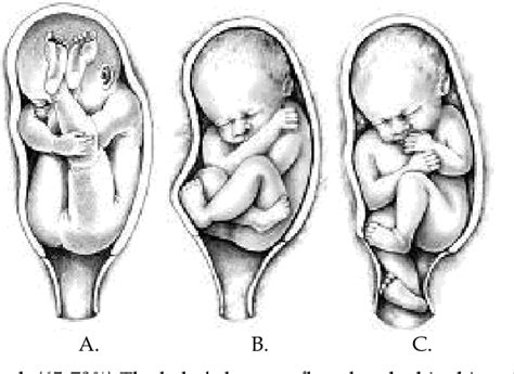 Figure 1 From The External Version In Modern Obstetrics Semantic Scholar
