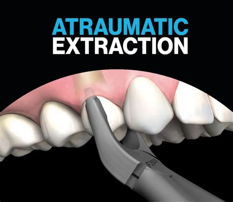 Immediate Tooth Implant After Extraction